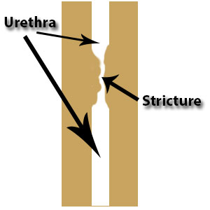 Why you might think you have a urethral stricture - Best Urologist NYC